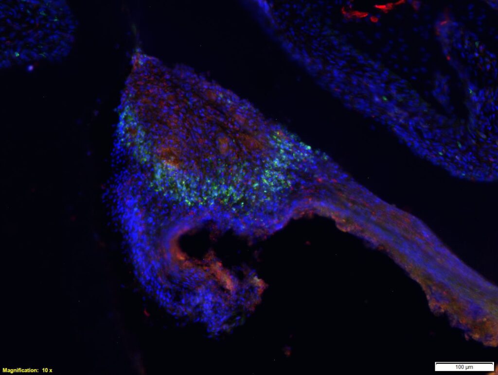 EXTIRPATE study: Irreversible Pulpitis – Newcastle Pain Research Group