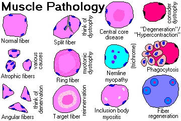 Myopathy | Musculoskeletal Genetics