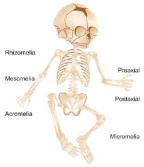 Skeletal dysplasias | Musculoskeletal Genetics